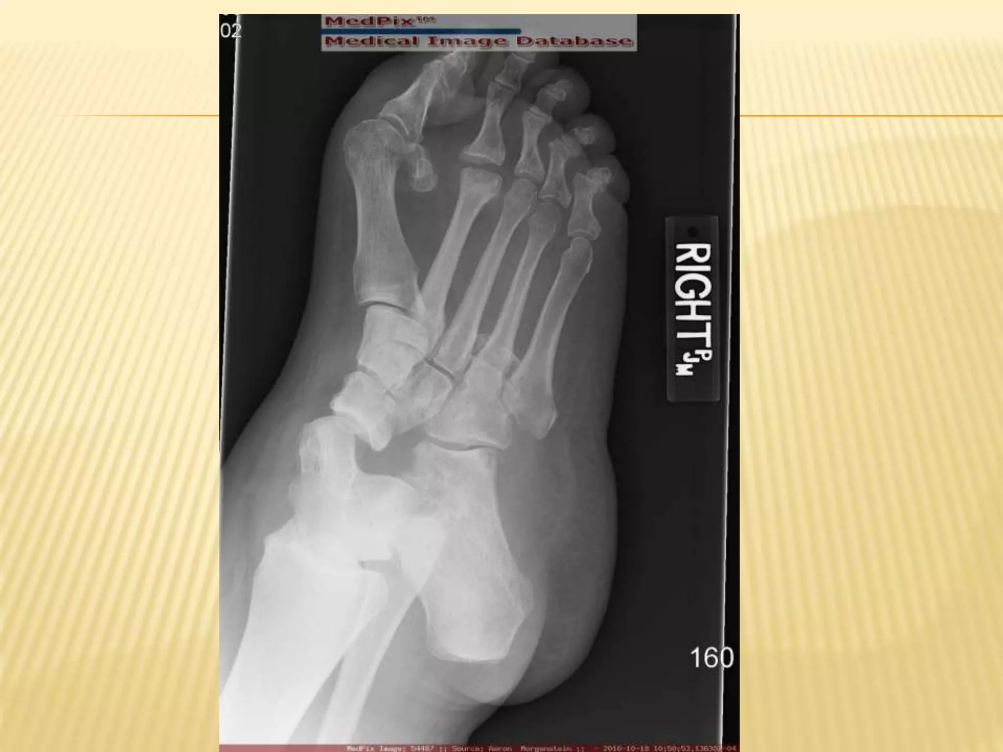 Charcot joint arthropathy and rehabilitation management | PPTX