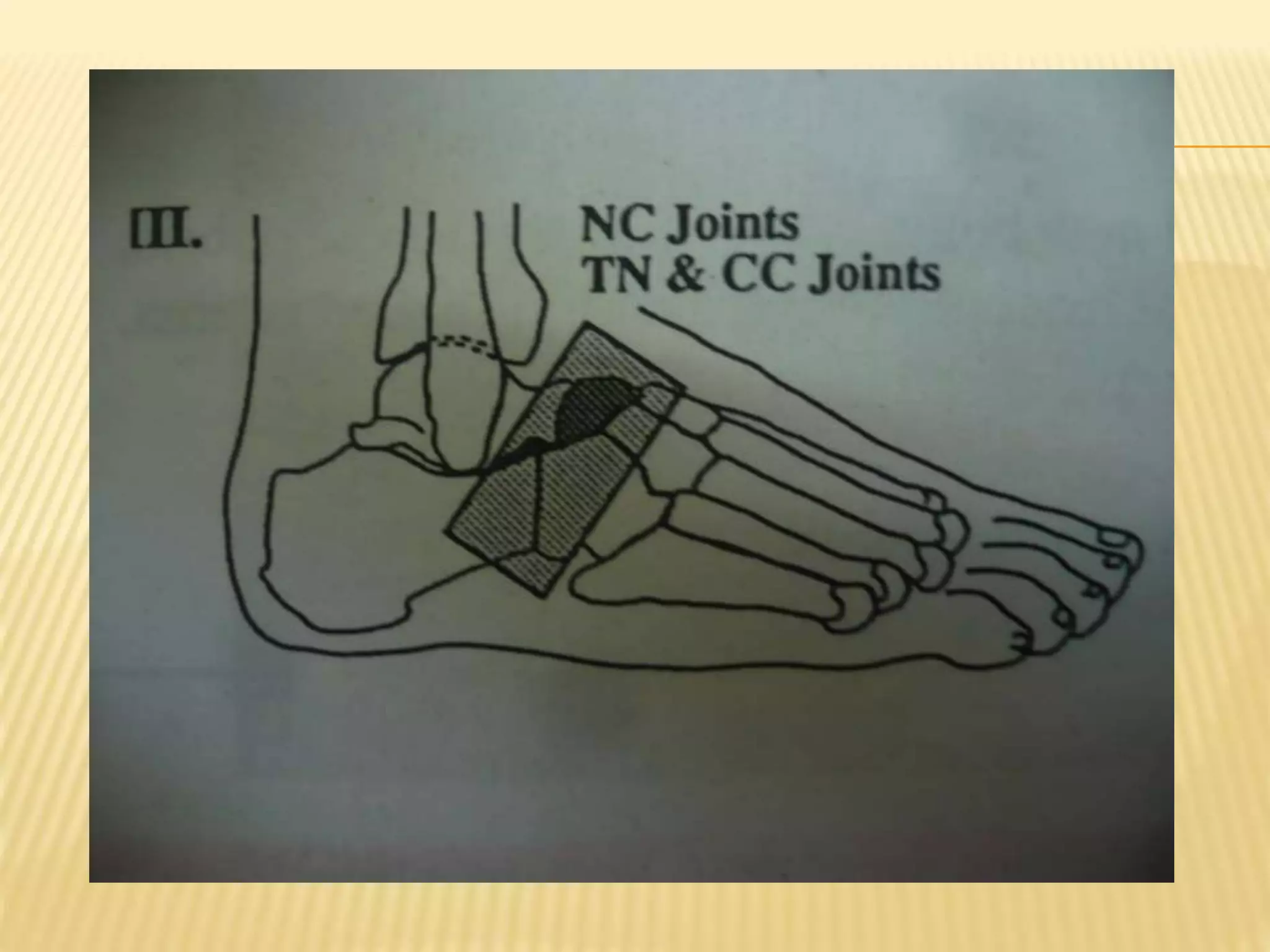 Charcot joint arthropathy and rehabilitation management | PPTX
