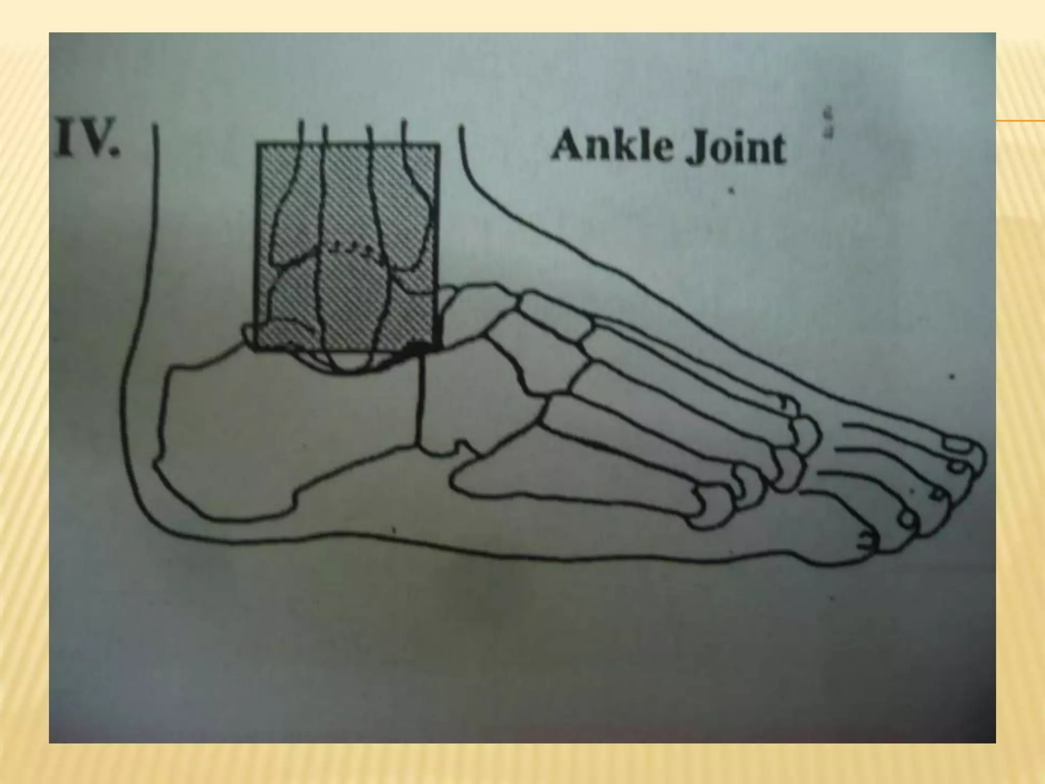 Charcot joint arthropathy and rehabilitation management | PPTX