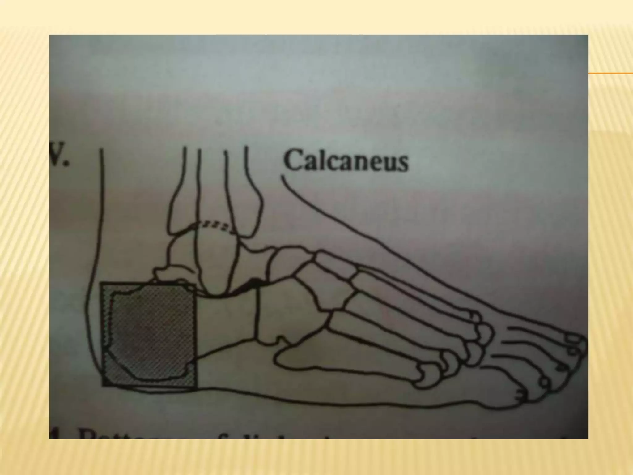 Charcot joint arthropathy and rehabilitation management | PPTX