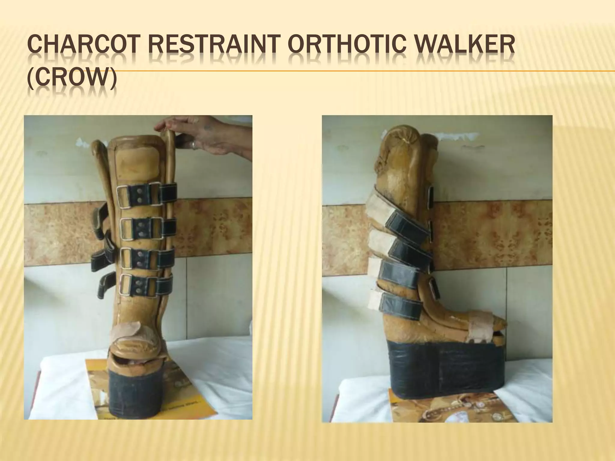Charcot joint arthropathy and rehabilitation management | PPTX