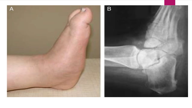 CHARCOT'S JOINT- ORTHOPEDIC PRESENTATION.pptx | Foot Health | Diseases ...