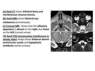 CHARGE SYNDROME.pptx