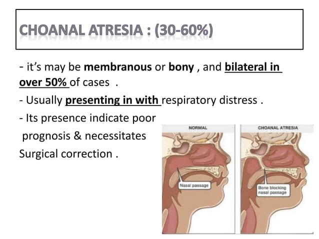 CHARGE SYNDROME.pptx | Ear, Nose and Throat Conditions | Diseases and ...