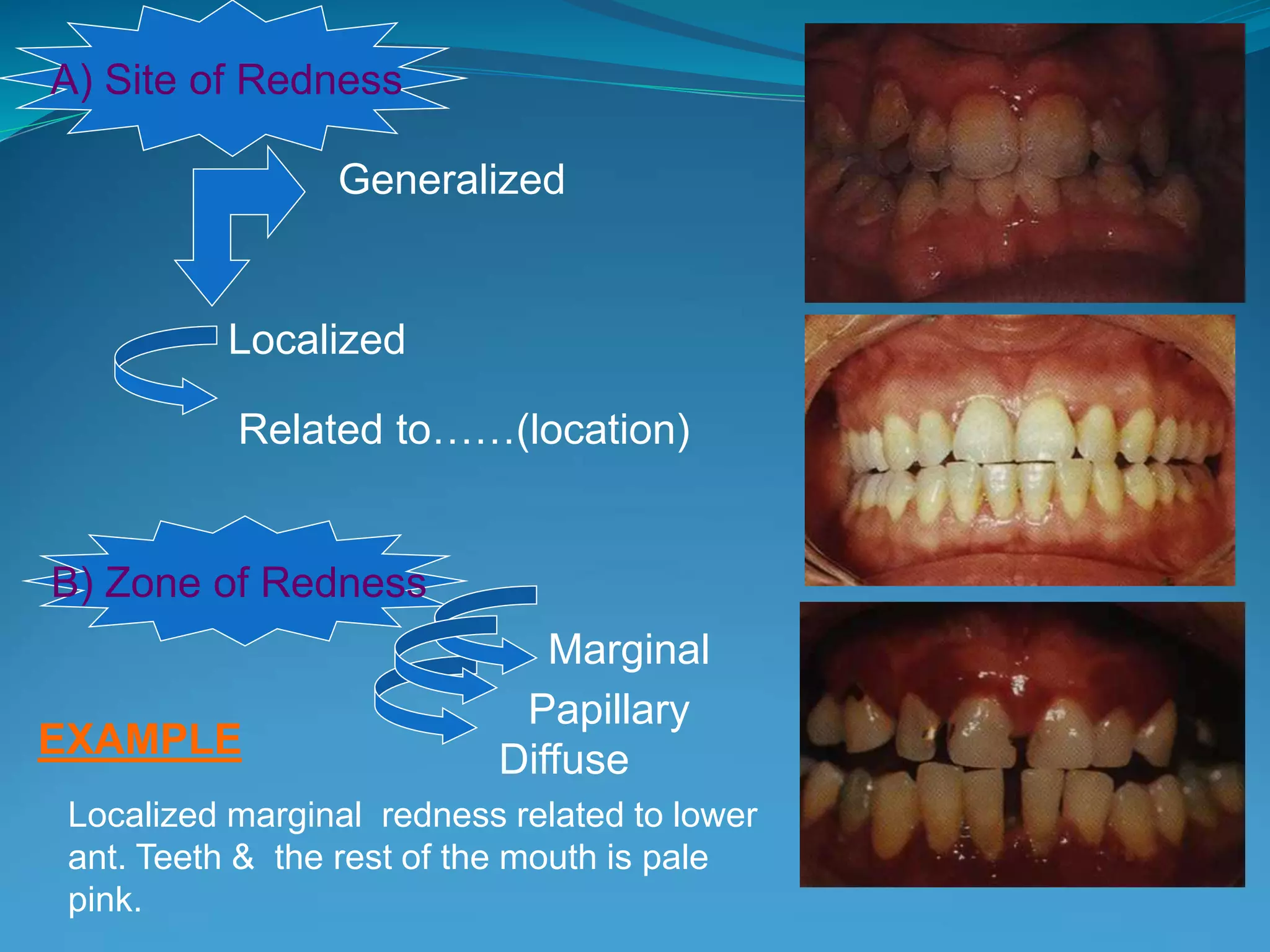 Periodontal Chart presentation | PPT
