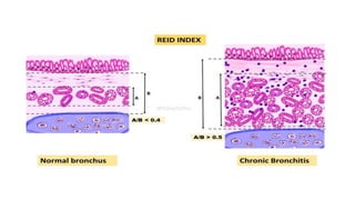 Lung, Robbins Pathology , COPD, Chronic Bronchitis | PPTX