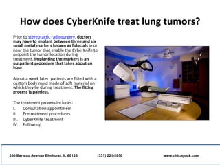 Lung Tumors: CyberKnife Treatment Overview | PDF