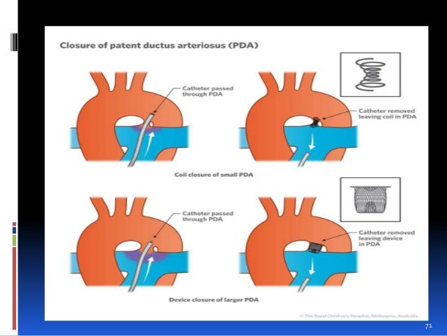 CONGENITAL HEART DISEASES