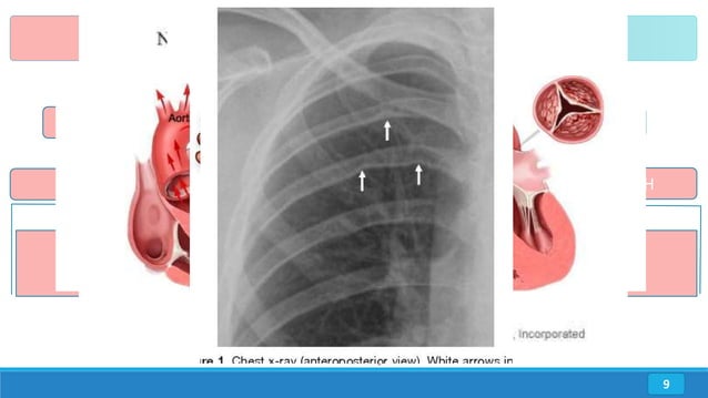 Congenital structural heart defects. | PPT