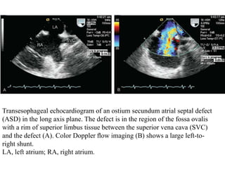 Echocardiography of CHD in Adults | PPTX