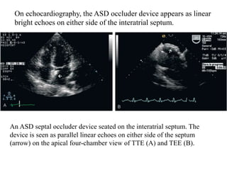Echocardiography of CHD in Adults | PPTX