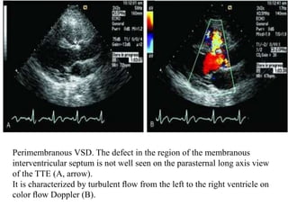 Echocardiography of CHD in Adults | PPTX