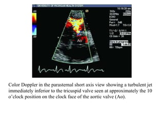 Echocardiography of CHD in Adults | PPTX
