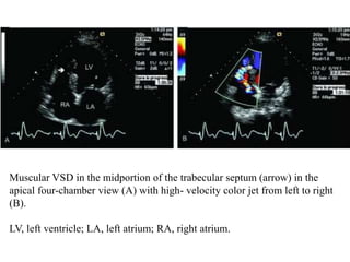 Echocardiography of CHD in Adults | PPTX