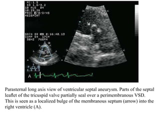 Echocardiography of CHD in Adults | PPTX