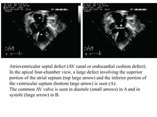 Echocardiography of CHD in Adults | PPTX