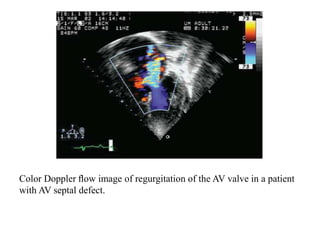 Echocardiography of CHD in Adults | PPTX