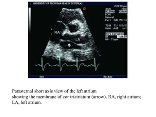 Echocardiography of CHD in Adults | PPTX