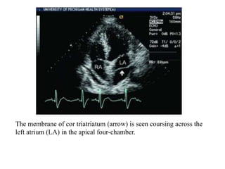 Echocardiography of CHD in Adults | PPTX