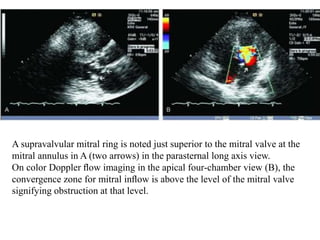 Echocardiography of CHD in Adults | PPTX