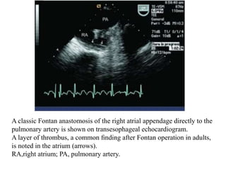 Echocardiography of CHD in Adults | PPTX