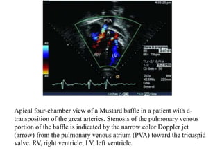Echocardiography of CHD in Adults | PPTX
