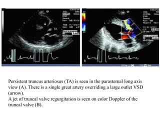 Echocardiography of CHD in Adults | PPTX