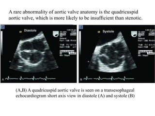 Echocardiography of CHD in Adults | PPTX