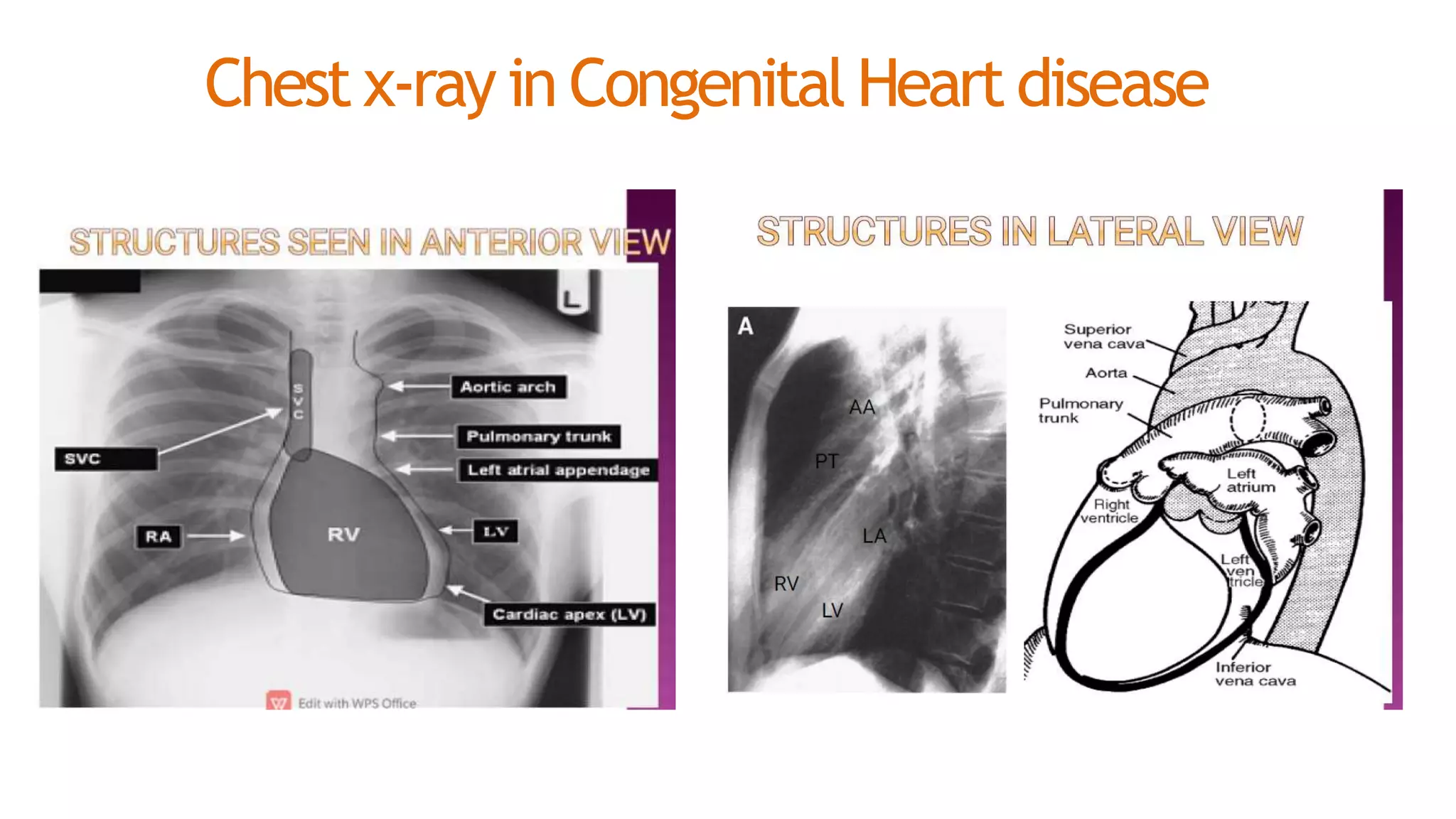 CHD CHEST X RAY.pptx