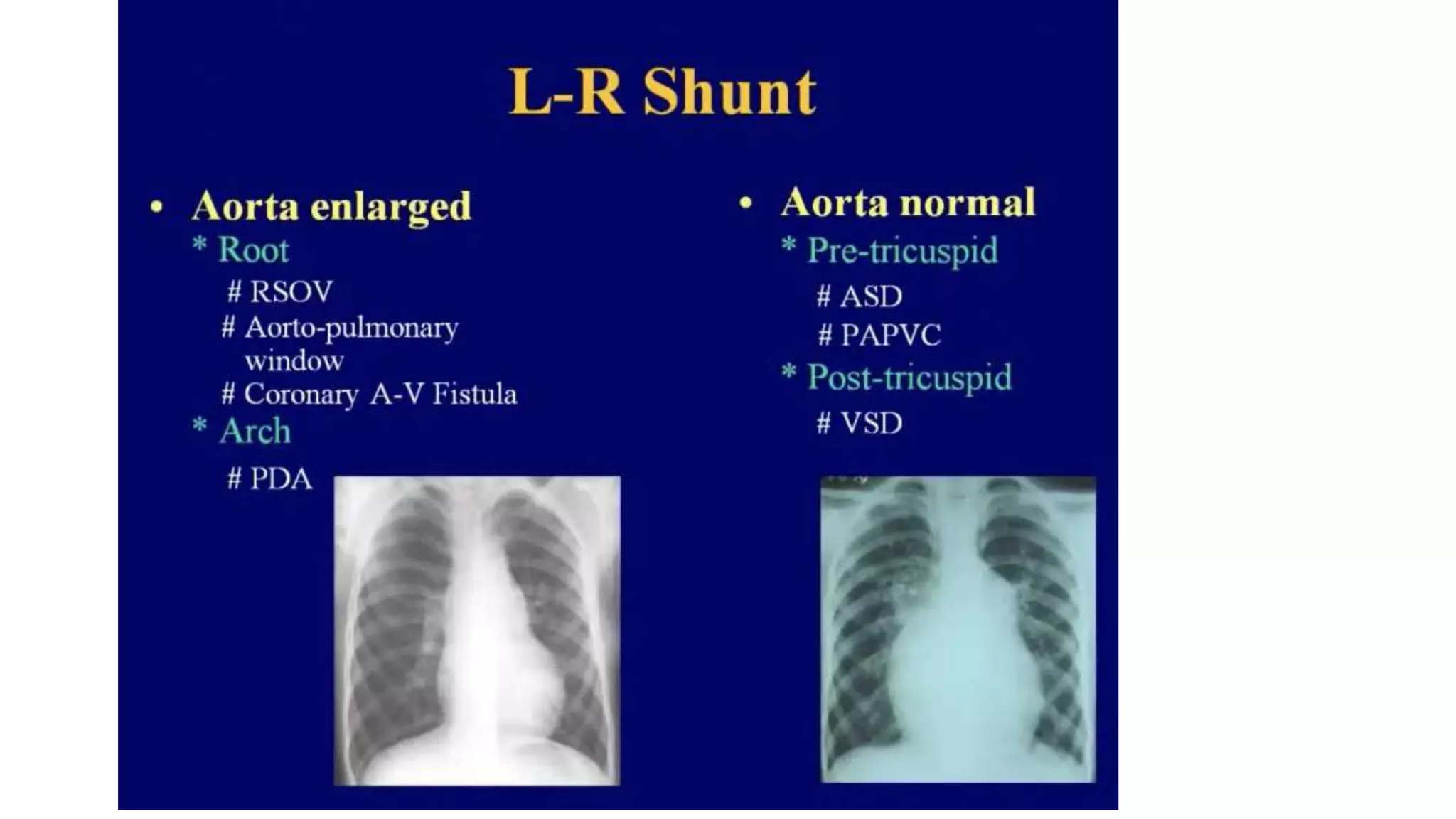 CHD CHEST X RAY.pptx