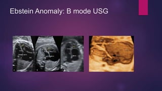 Antenatal Diagnosis of Fetal Heart Disease | PPTX