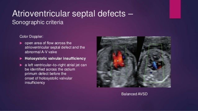 Antenatal Diagnosis of Fetal Heart Disease