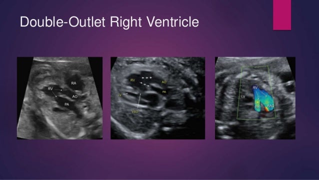 Antenatal Diagnosis of Fetal Heart Disease