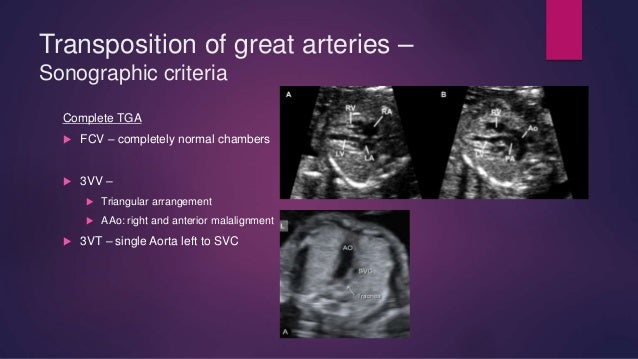 Antenatal Diagnosis of Fetal Heart Disease
