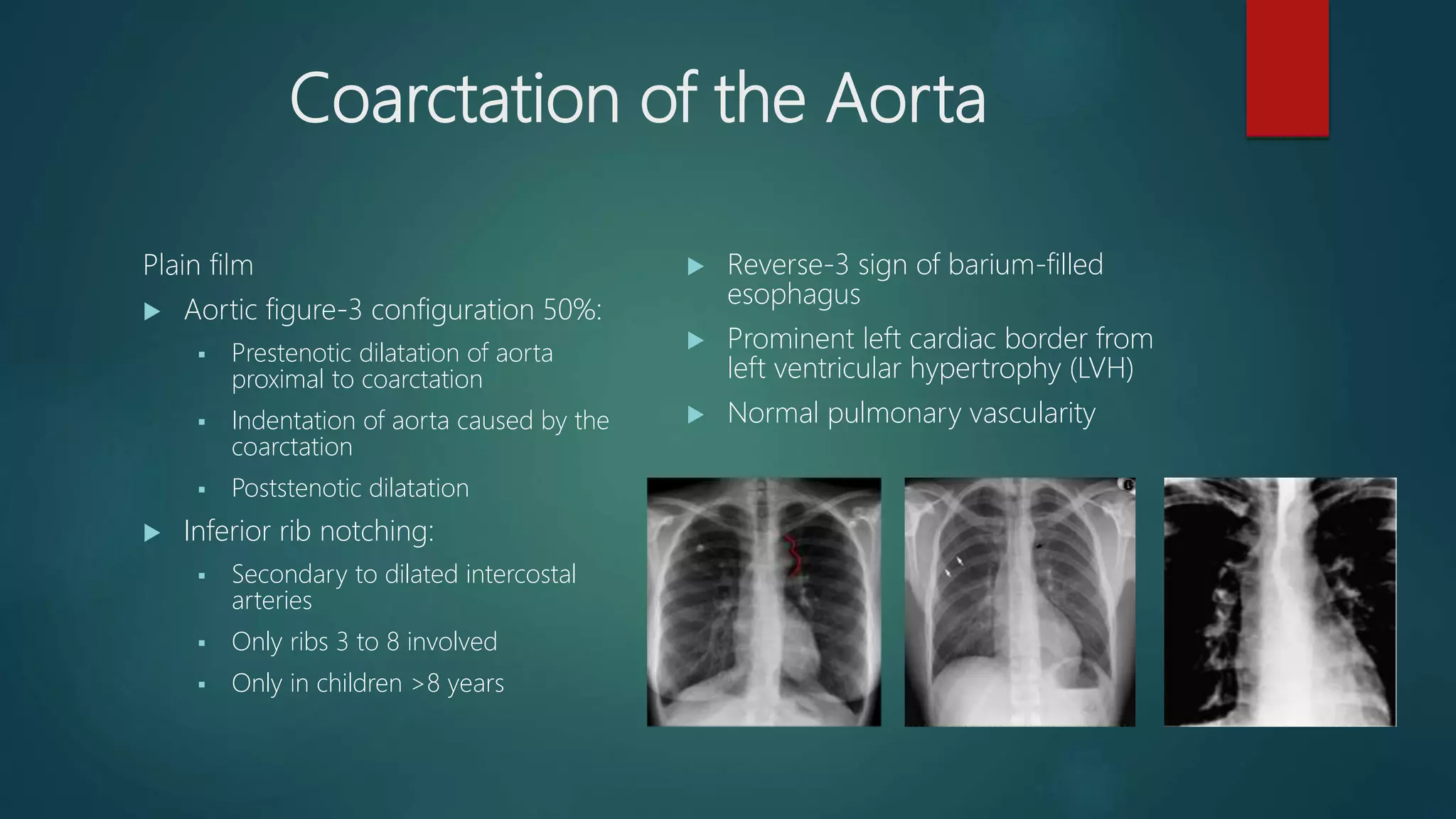Radiographic Presentation of Congenital Heart Disease | PPTX