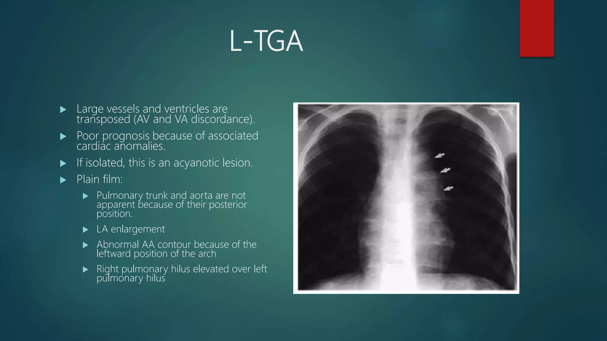 Radiographic Presentation of Congenital Heart Disease | PPTX