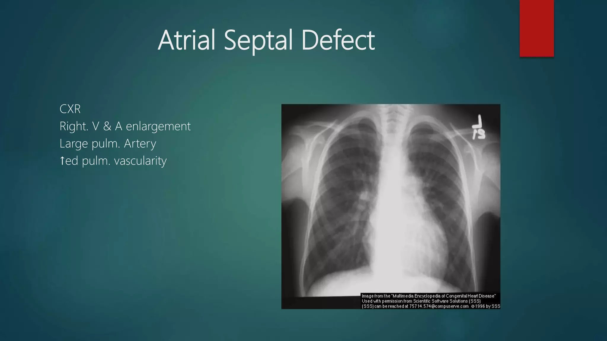 Radiographic Presentation of Congenital Heart Disease | PPTX