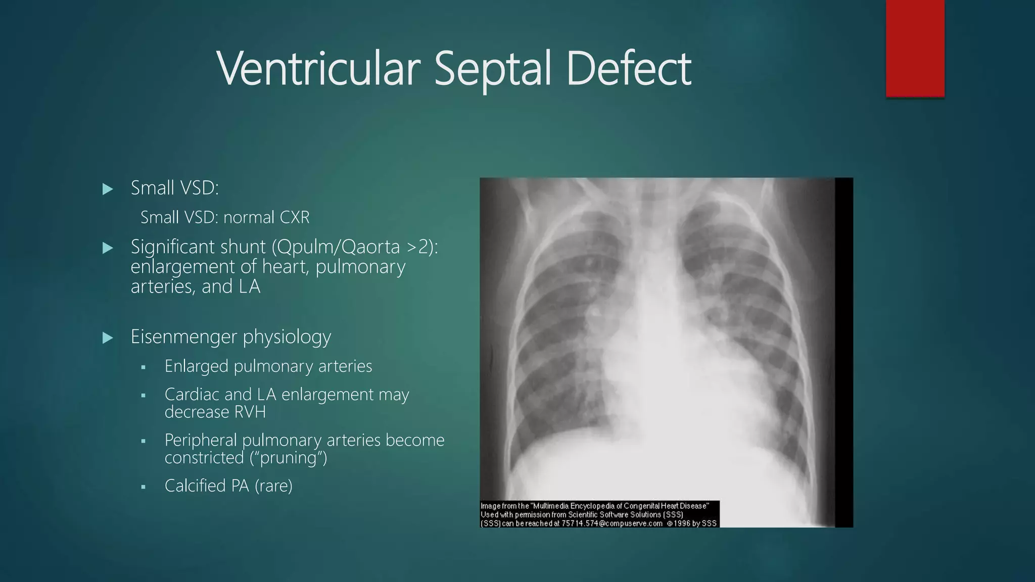 Radiographic Presentation of Congenital Heart Disease | PPTX