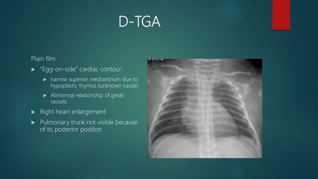 Radiographic Presentation of Congenital Heart Disease | PPTX | Heart ...