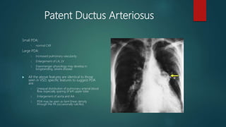 Radiographic Presentation of Congenital Heart Disease | PPTX