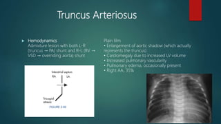 Truncus Arteriosus X Ray