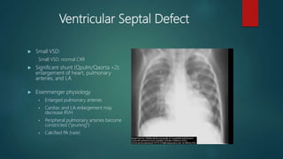 Ventricular Septal Defect X Ray
