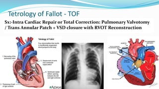 Congenital Heart Disease & Surgical Management | PPTX