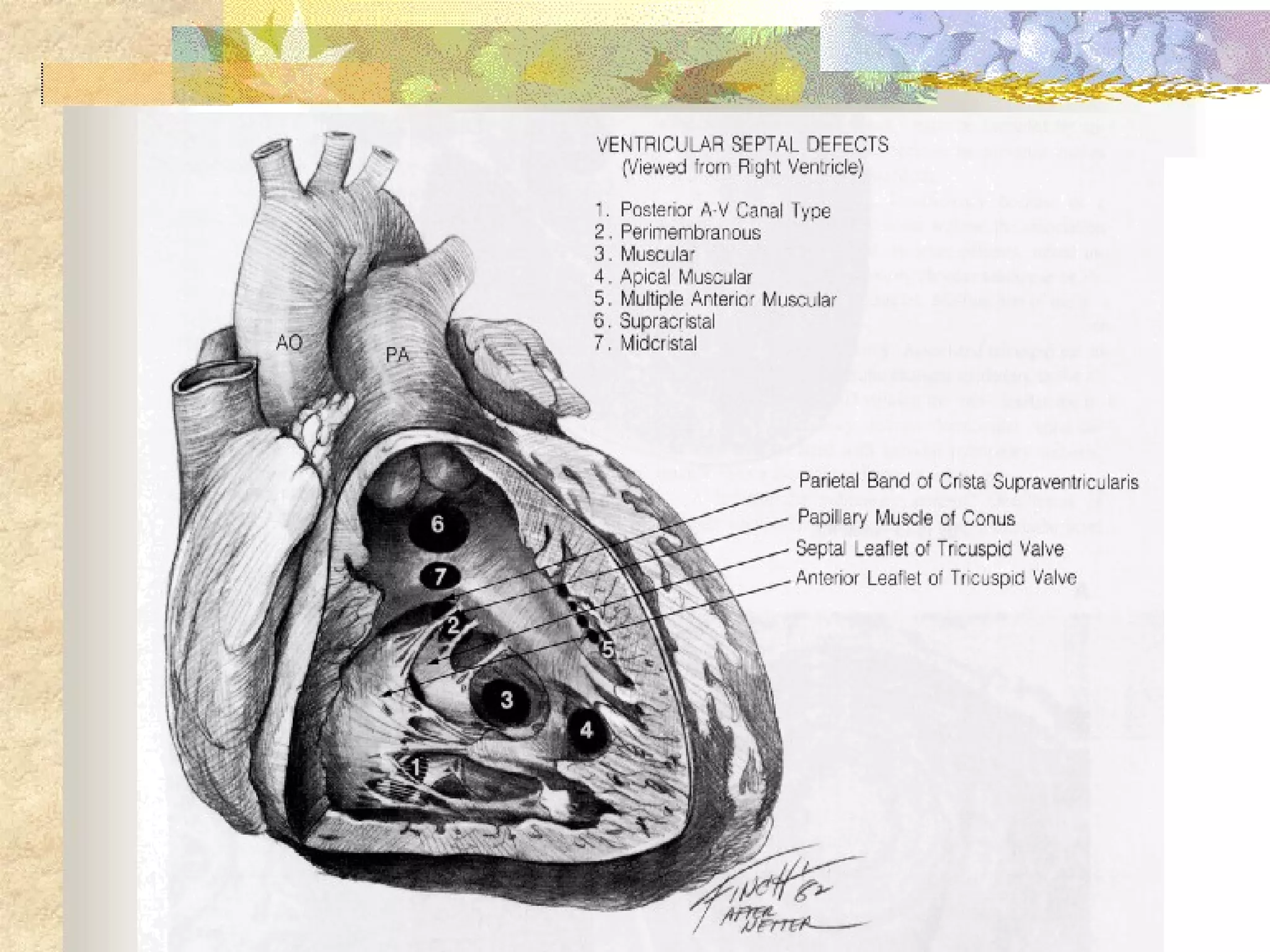 Approach to a Child with Congenital Heart Disese | PPT