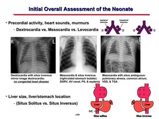 Congenital Heart Disease Screening in the Neonate | PPT