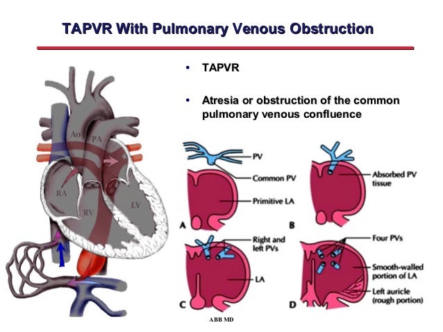 Congenital Heart Disease Screening in the Neonate