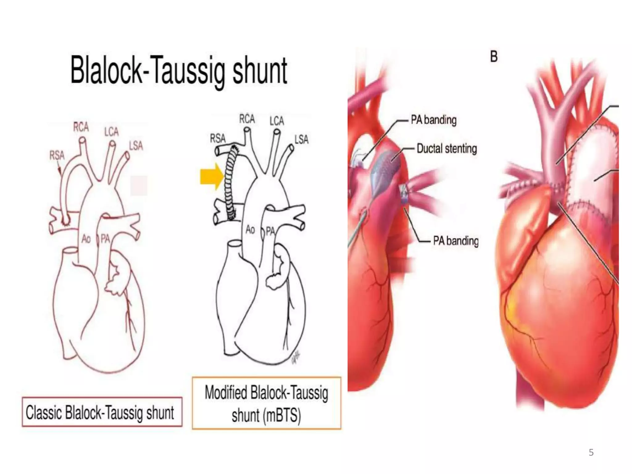 Chd surgical procedure | PPTX
