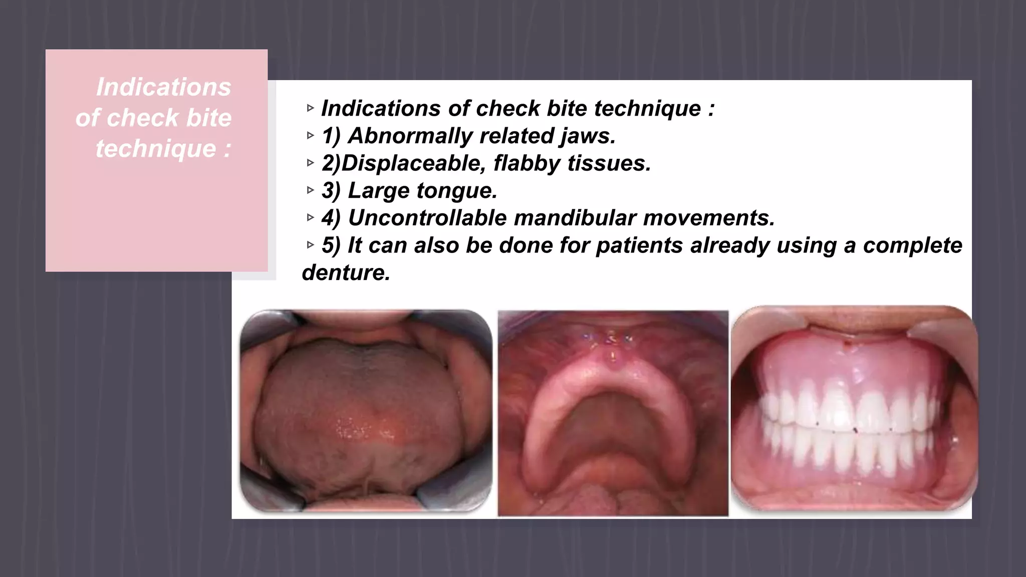 Check bite technique | PDF