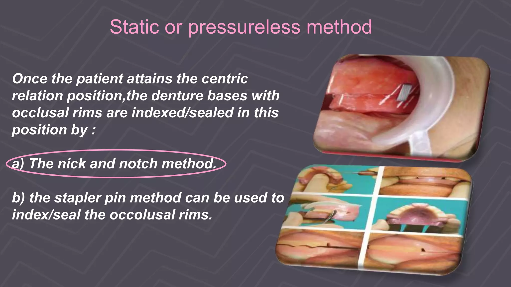 Check bite technique | PDF
