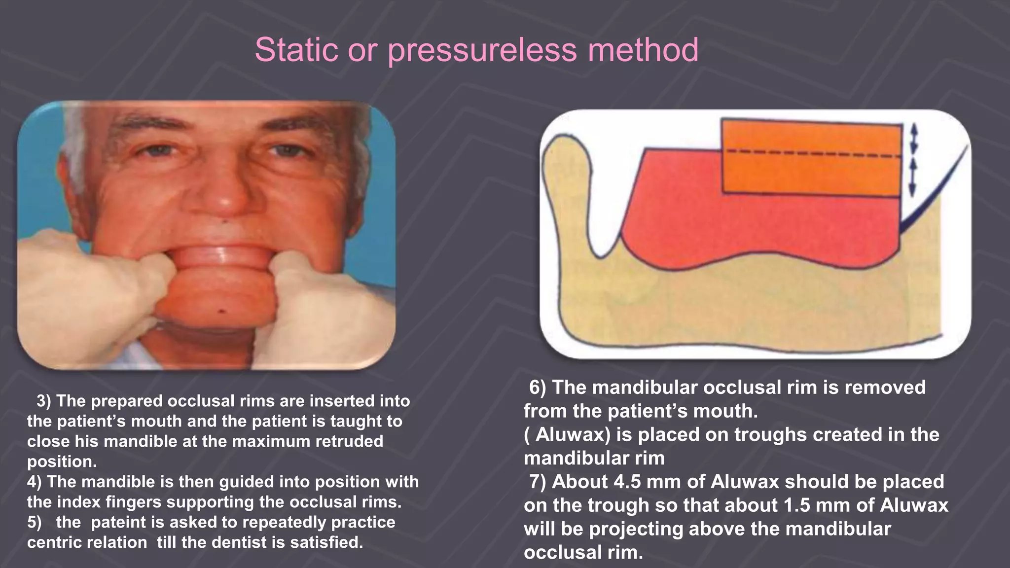 Check bite technique | PDF